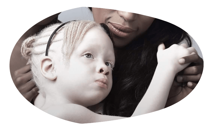 About albinism – Albinism Foundation of Zambia – AFZ