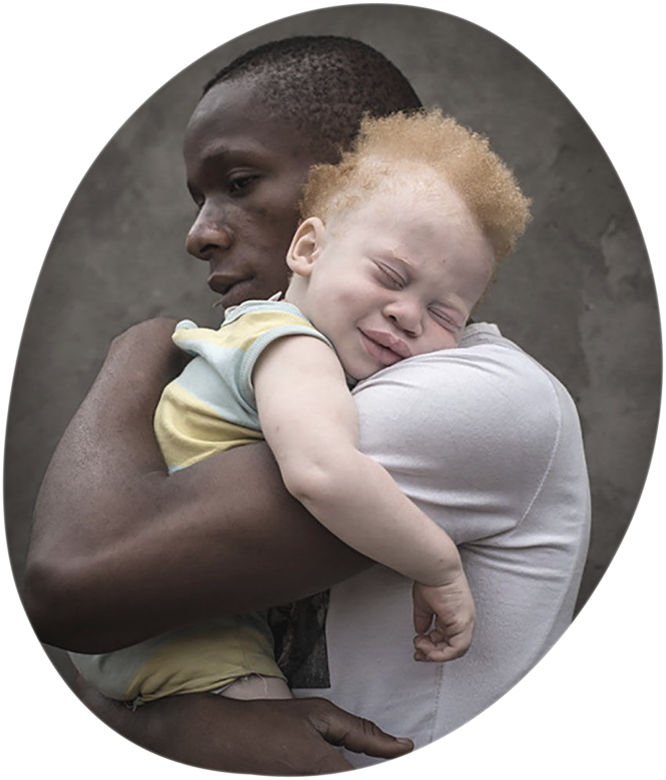 About albinism – Albinism Foundation of Zambia – AFZ