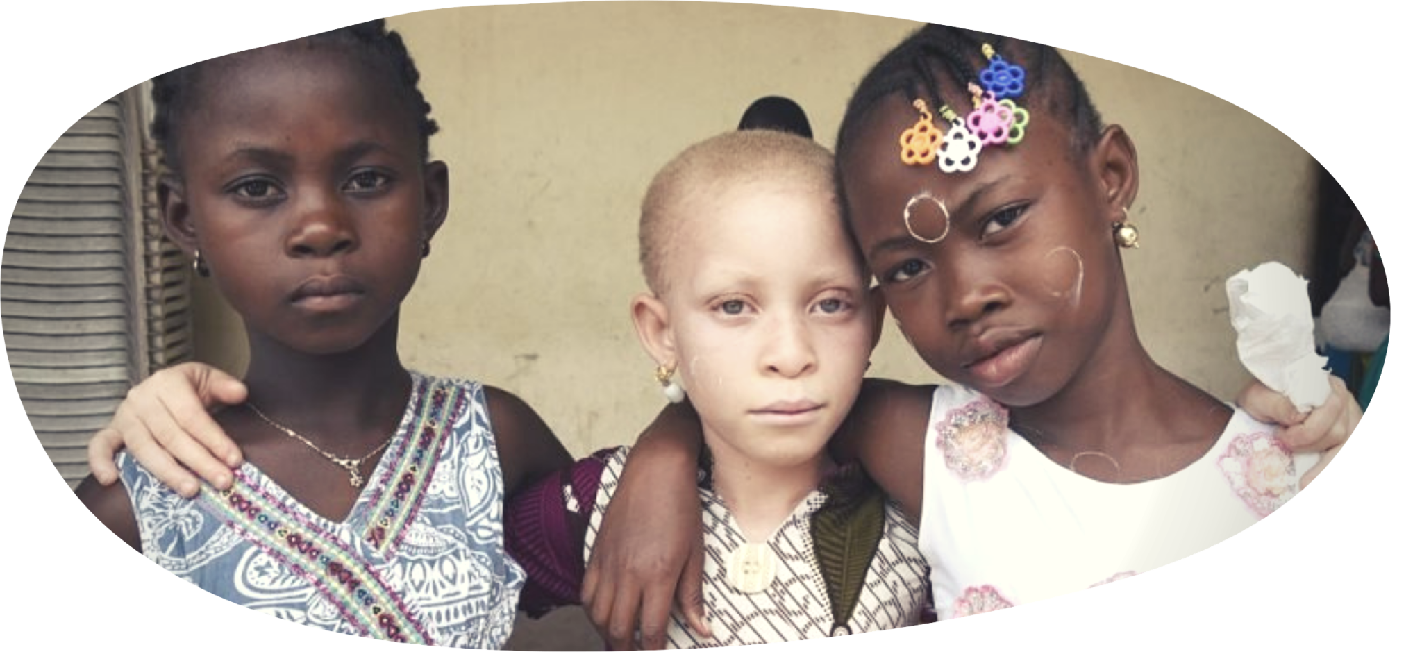 Membership – Albinism Foundation of Zambia – AFZ
